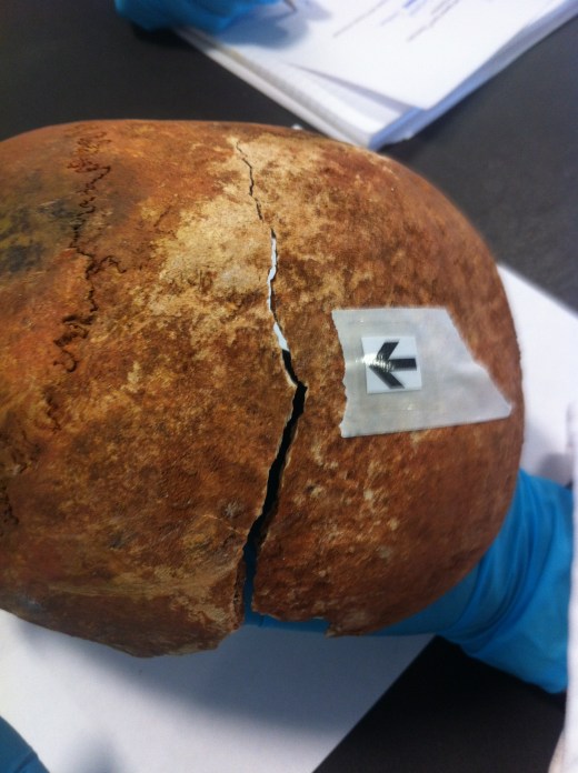 Skeleton fractures – All Things AAFS!