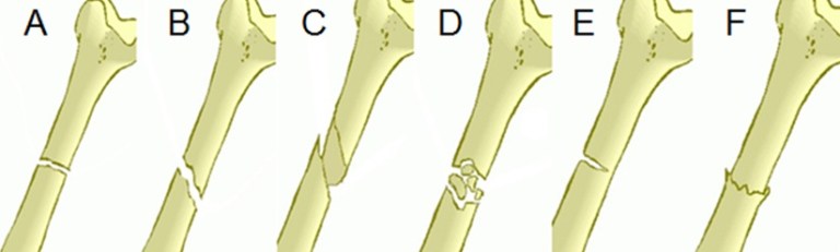 Quick Tips: Fracture Types – The Basics. – All Things AAFS!